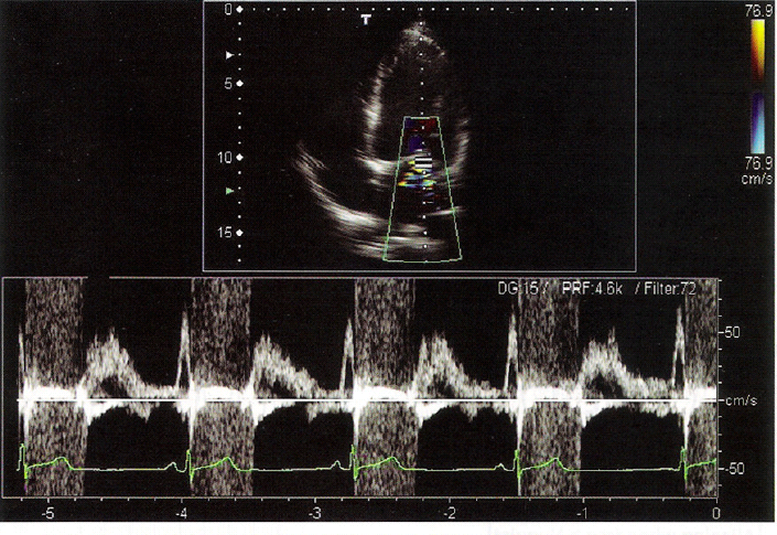 What is Aliasing? Moreover, how can it be prevented?