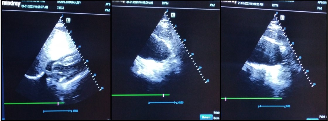 ECHO IN ACUTE CHEST PAIN