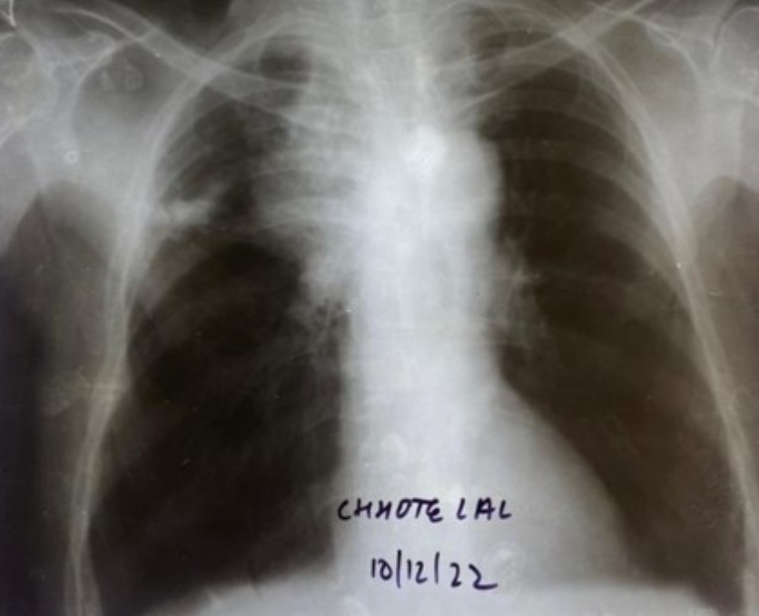 MIMC-MUCORMYCOSIS PRESENTING AS INTRA-THORACIC MASS WITH SUPERIOR VENA ...