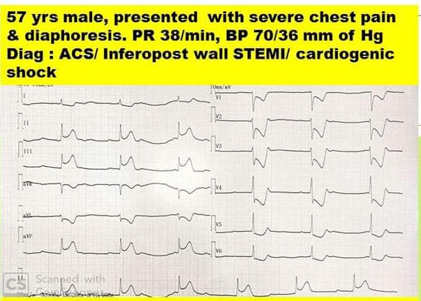 57-Year-Old Male with Severe Chest Pain, Diaphoresis, Bradycardia, and ...