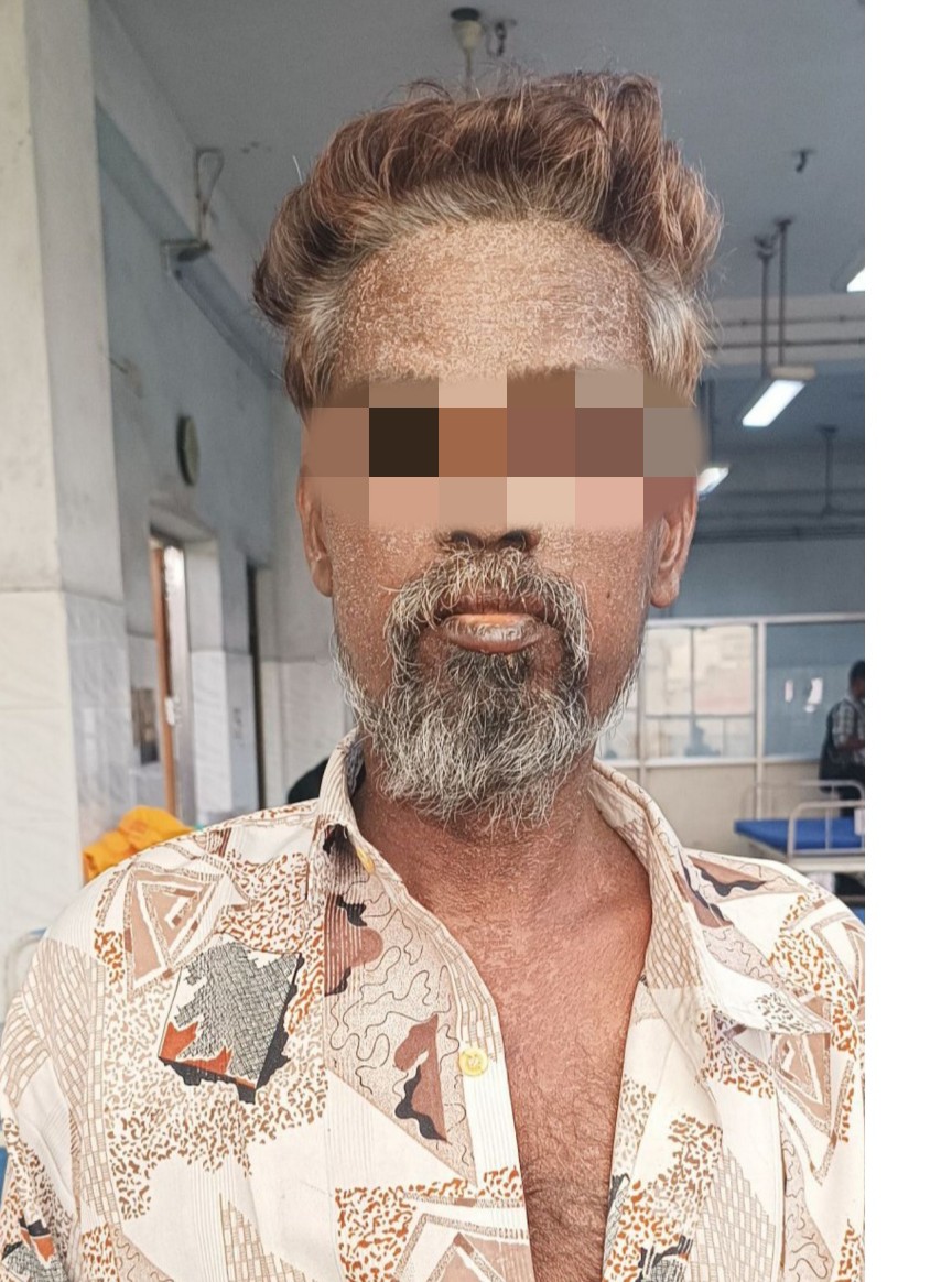 Case on meropenem induced dermatitis